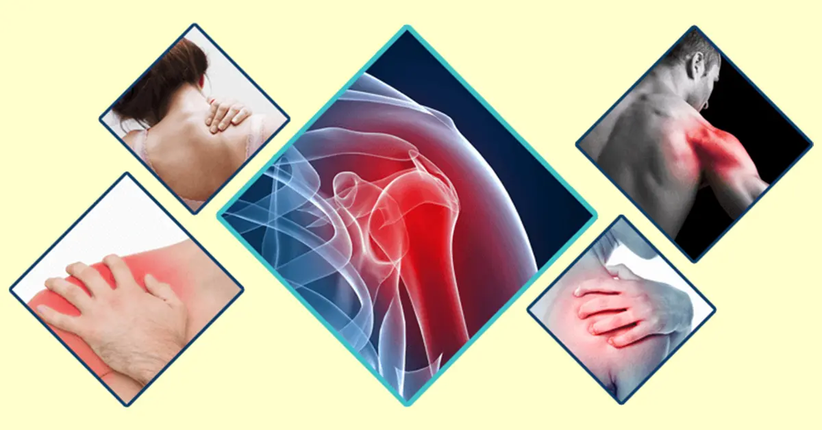 Frozen Shoulder Exercises Stages And Physiotherapy Treatment
